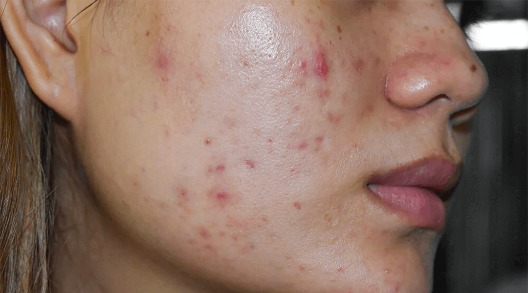 Types of Acne Scars (with Pictures) – Clearly Basics US